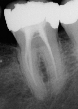 Mandibular Left First Molar (LL6) Root Canal Retreatment – Gutta-percha ...