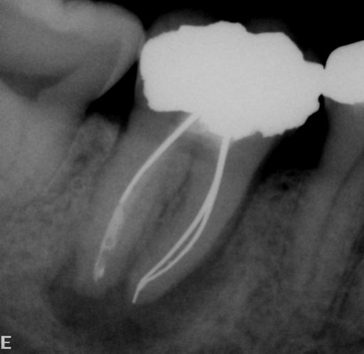 Mandibular Right Second Molar (LR7) Root Canal Retreatment – Silver ...