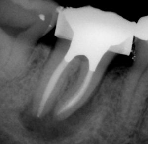 Mandibular Right Second Molar (LR7) Root Canal Retreatment – Silver ...