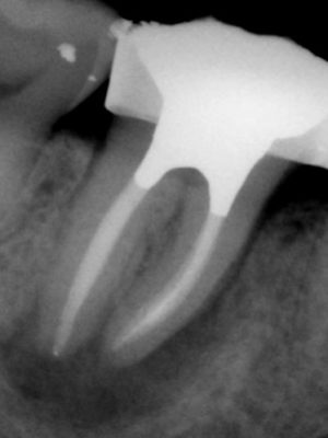 Case Studies Archive - Huddersfield Endodontics