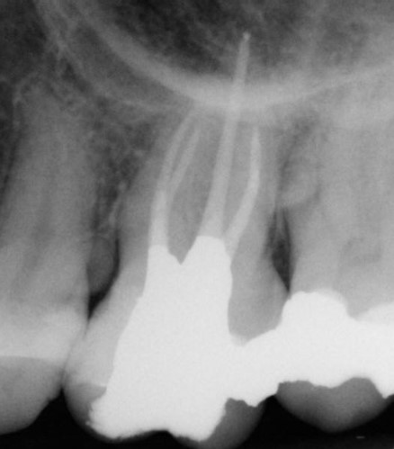 Maxillary Left First Molar (UL6) Root Canal Retreatment – Fractured ...