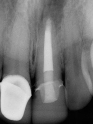 Case Studies Archive - Huddersfield Endodontics