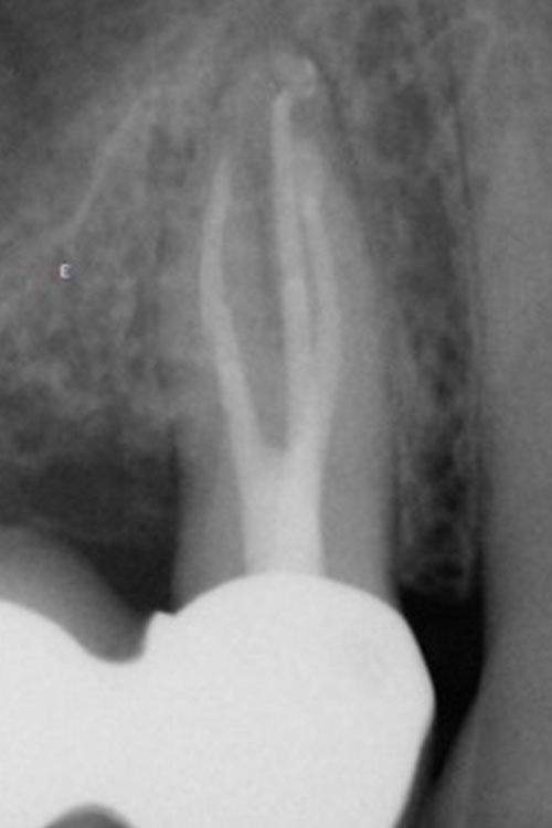 More Case Studies - Huddersfield Endodontics | Root Canal Treatments
